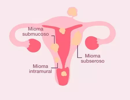 fibroids