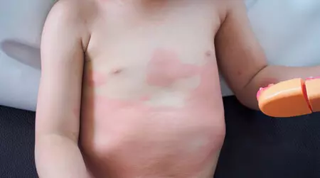 wrticaria