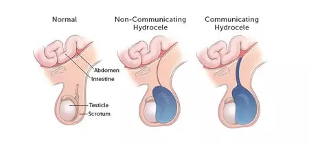 hidrocela