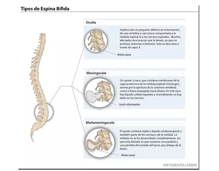 spina bifida