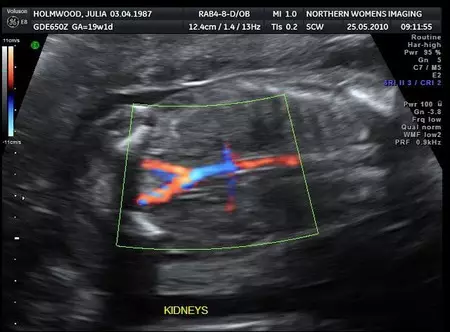I-Doppler ultrasound