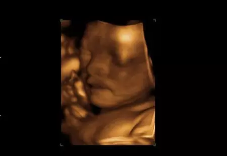 I-ultrasound4D