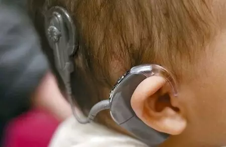 为重度耳聋婴儿植入人工耳蜗，它们是什么以及它们如何工作？