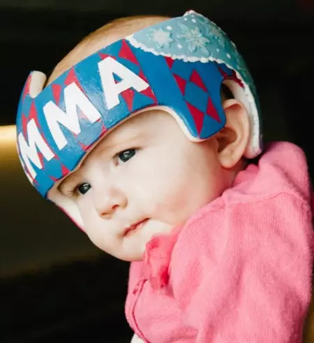 helmet-plagiocephaly