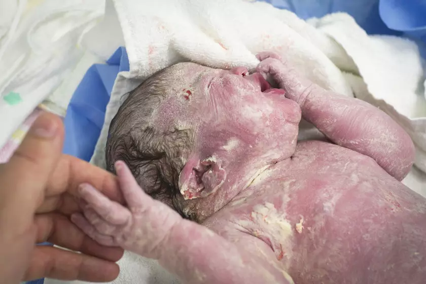 Τι είναι το vernix caseosa και γιατί είναι σημαντικό να μην καθαρίζετε το μωρό μετά τη γέννηση