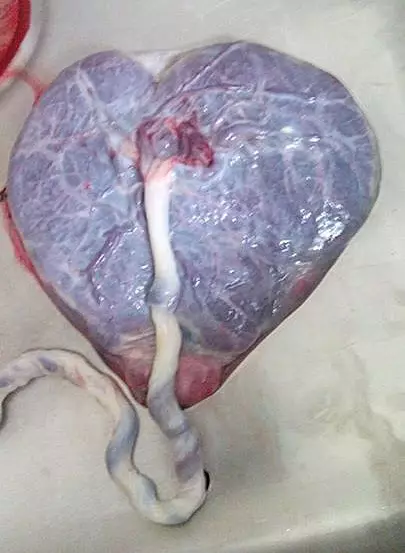 PlacentaHeart