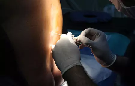 epidural