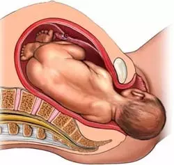 i-dystocia