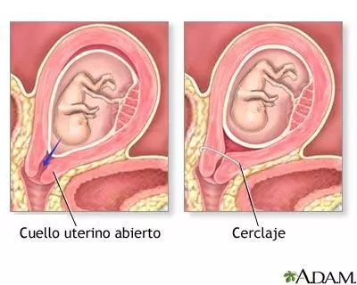 cerclage