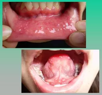 gingival stomatitis