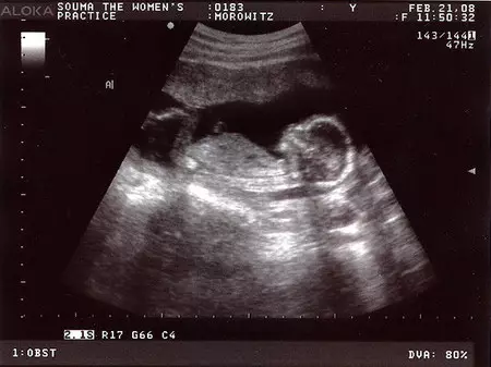 懷孕15週的寶寶