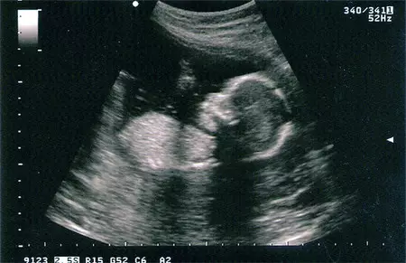 Fetus 18 setmanes