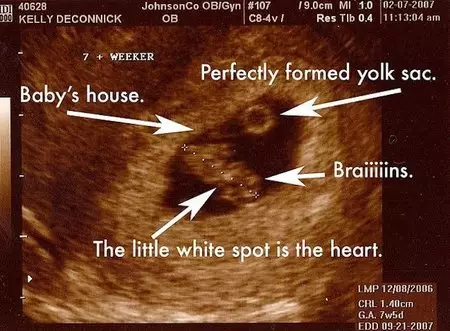 ultrasound sayo sa pagmabdos