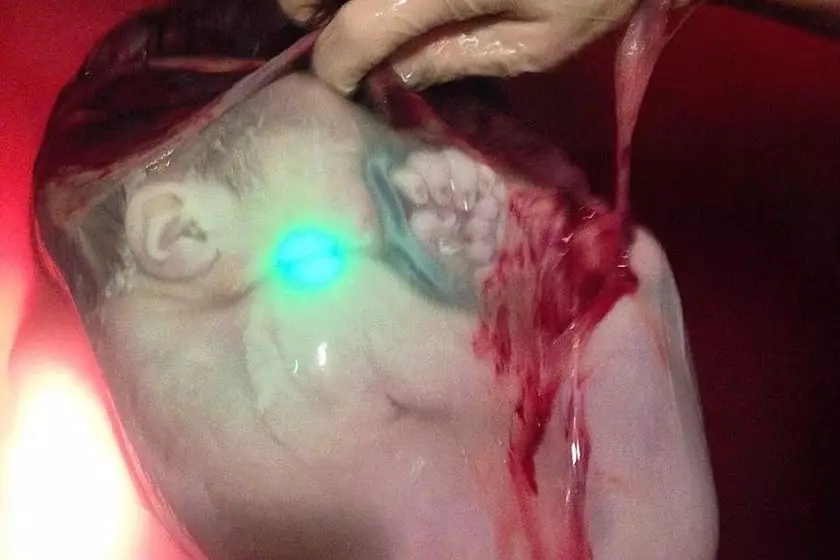 Ein unglaubliches Foto zeigt, wie Babys bei der Geburt mit intaktem Sack im Mutterleib sind