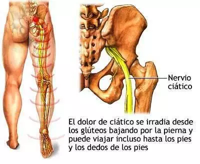 Sciatica жана кош бойлуулук: бул эмне жана аны менен кантип күрөшүү керек