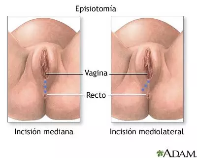 Doğum: epizyotomi