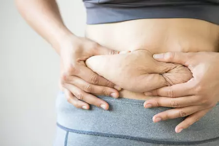 Woman Stretch Marks Belly