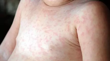 Roseola-exantema-sexta-enfermidade súbita