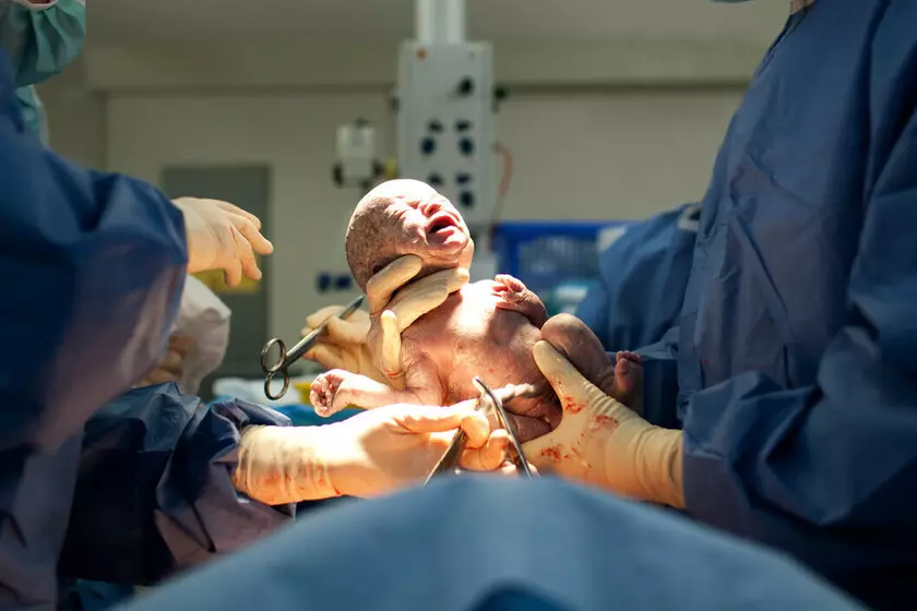 Sashen Cesarean mataki-mataki: yadda wannan aikin ke faruwa don a haifi jariri