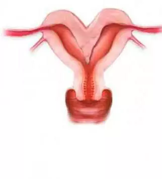 bicornuate uterus