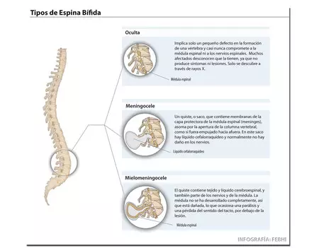 Gráfico de espina bífida